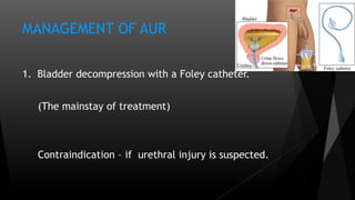 Acute Urinary Retention | PPTX