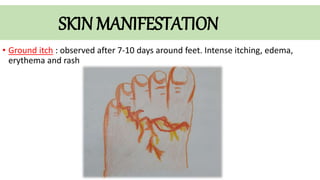 hookworm infection | PPTX