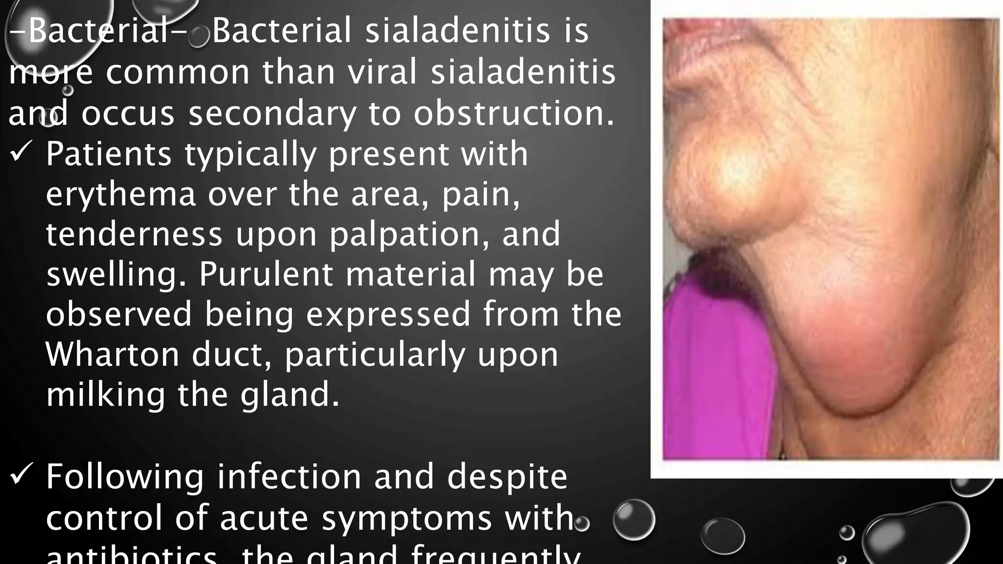 DIFFERENTIAL DIAGNOSIS OF SUBMANDIBULAR SWELLINGS FOR UGs | PPTX