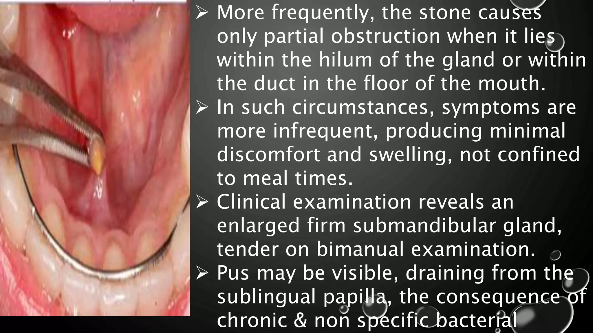 DIFFERENTIAL DIAGNOSIS OF SUBMANDIBULAR SWELLINGS FOR UGs | PPTX