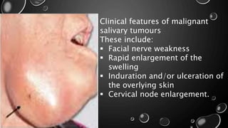 DIFFERENTIAL DIAGNOSIS OF SUBMANDIBULAR SWELLINGS FOR UGs | PPTX