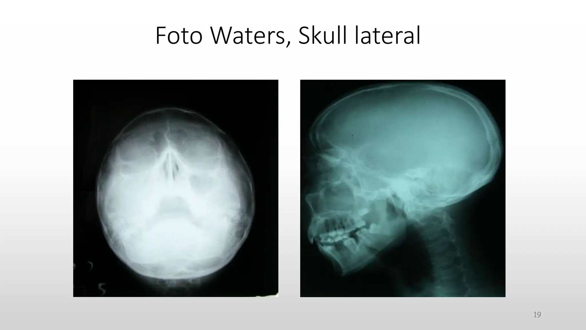 Angiofibroma Nasofaring Juvenile modul ARF THT-BKL.pptx