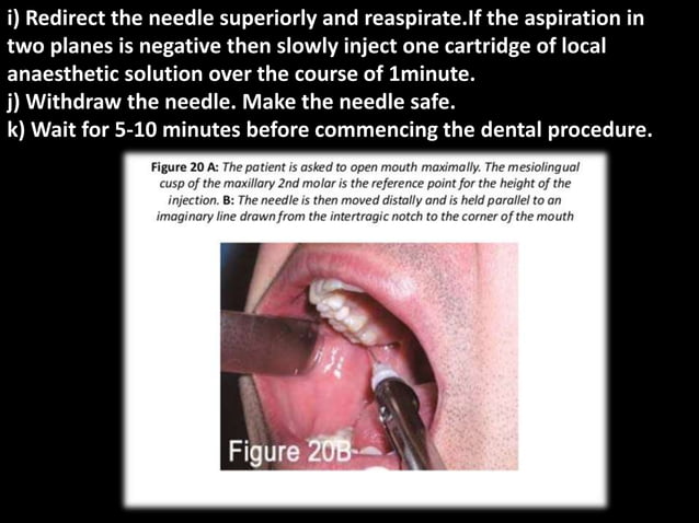 MANDIBULAR NERVE BLOCK. | PPTX | Ear, Nose and Throat Conditions ...