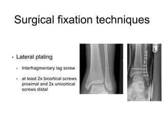 Anke fx fixation - Derek Park | PPT