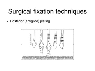 Anke fx fixation - Derek Park | PPT
