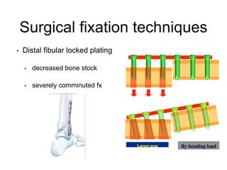 Anke fx fixation - Derek Park | PPT