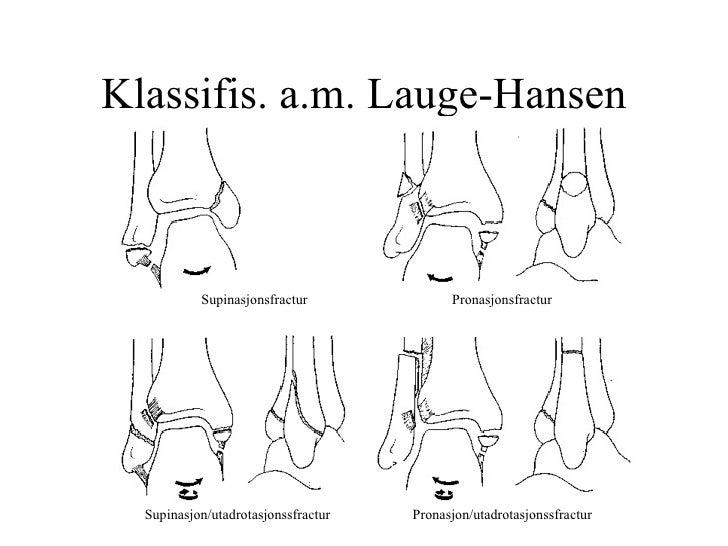 Ankle Hansen Lauge Classification Fractures Injuries Reduction Figure ...