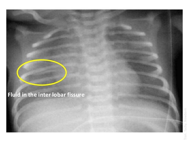 Respiratory Distress in New born