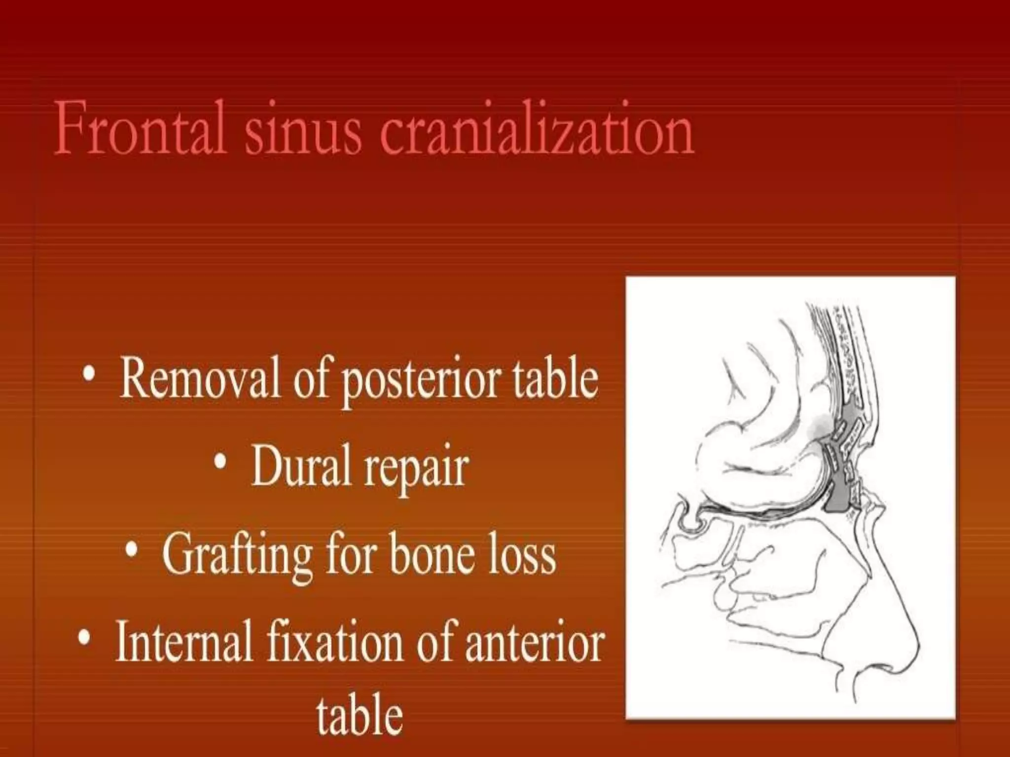 FRONTAL BONE FRACTURE | PPTX