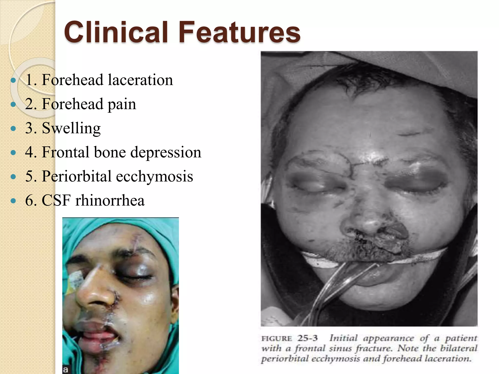 FRONTAL BONE FRACTURE | PPTX