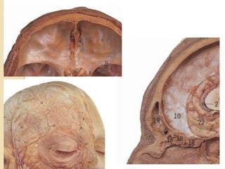 FRONTAL BONE FRACTURE | PPTX