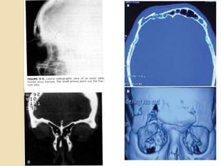 FRONTAL BONE FRACTURE | PPTX