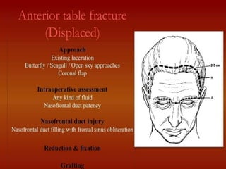 FRONTAL BONE FRACTURE | PPTX