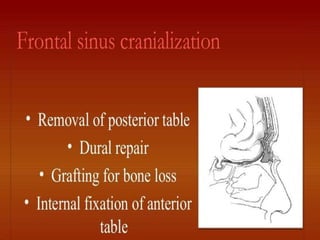 FRONTAL BONE FRACTURE | PPTX