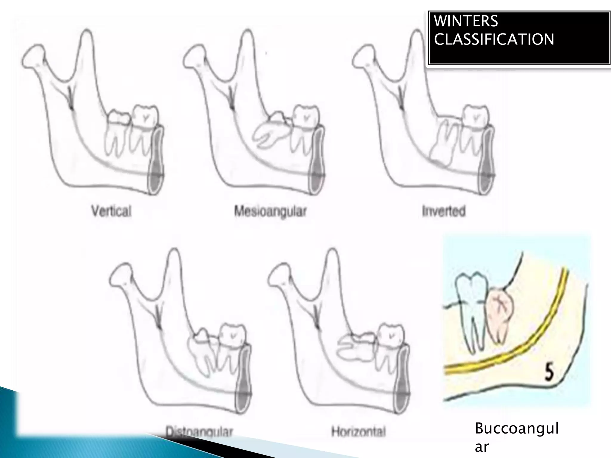 MANDIBULAR 3RD MOLAR IMPACTION | PPTX