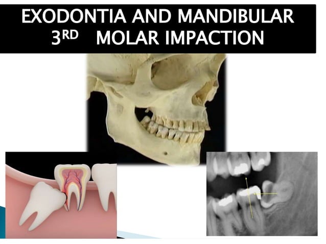 MANDIBULAR 3RD MOLAR IMPACTION | PPTX | Dental Health | Diseases and ...