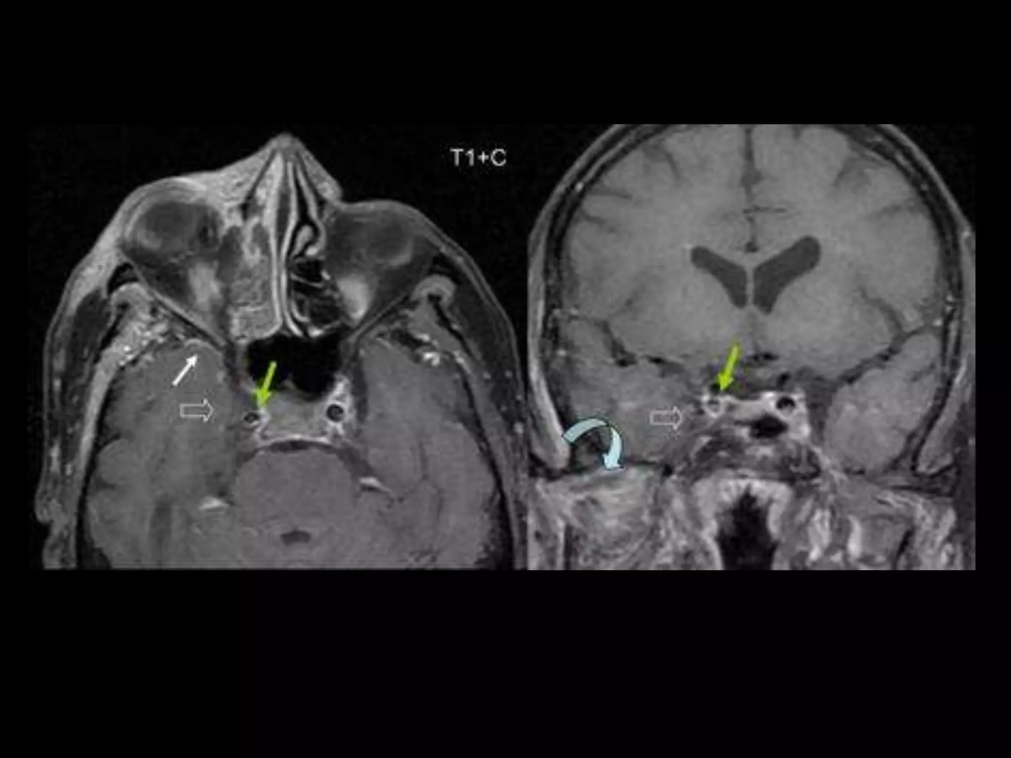 CAVERNOUS SINUS THROMBOSIS | PPTX