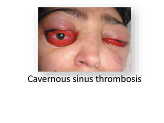 CAVERNOUS SINUS THROMBOSIS | PPTX