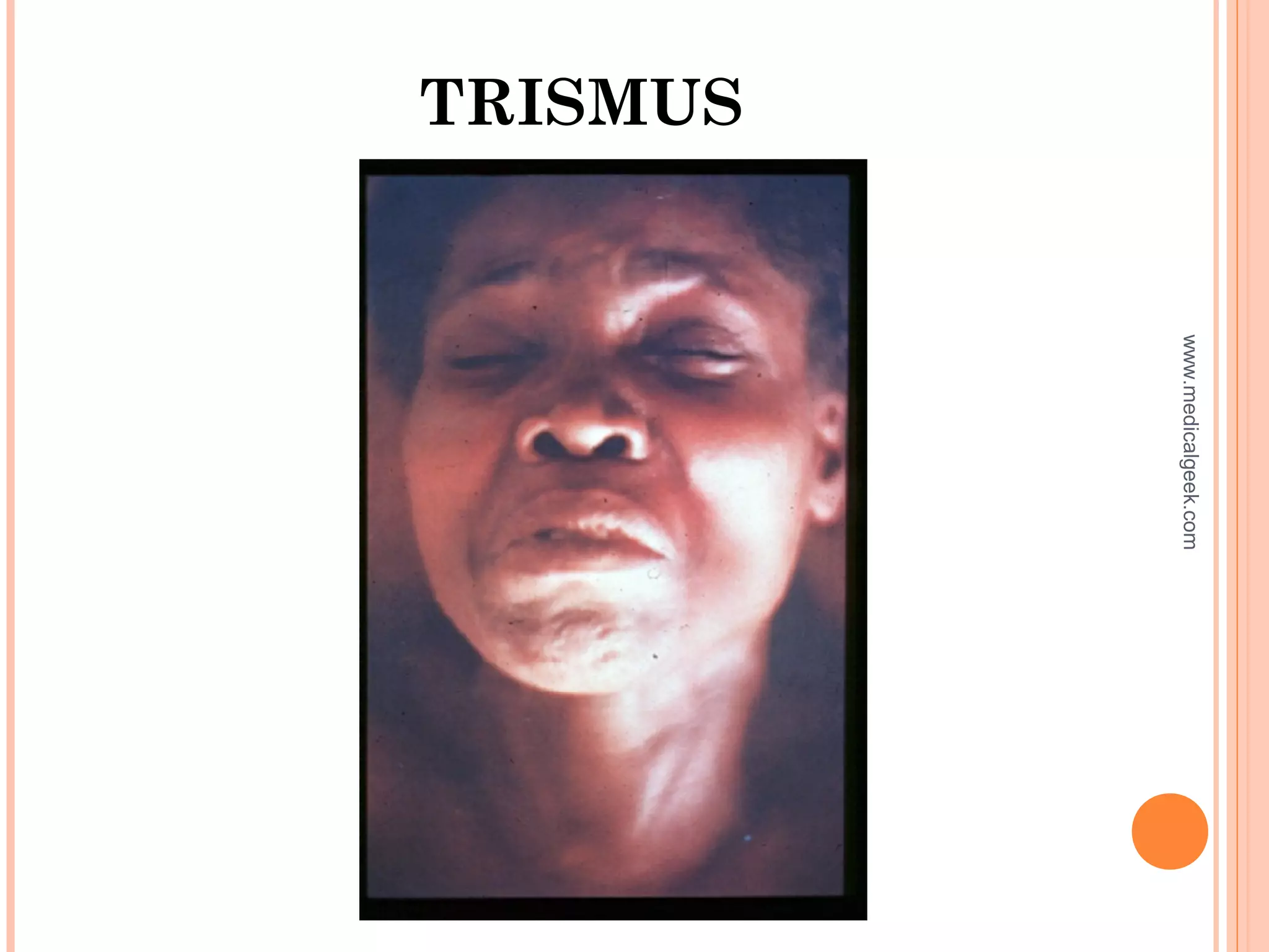 Tetanus Presentation | PPT