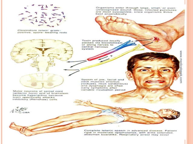 Tetanus Presentation | PPT