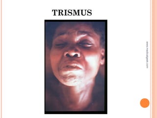 Tetanus Presentation | PPT