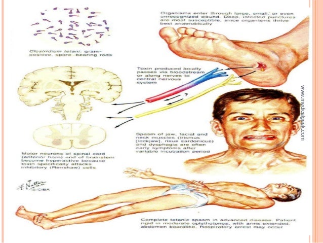 Tetanus Presentation