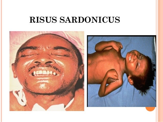 Tetanus Presentation