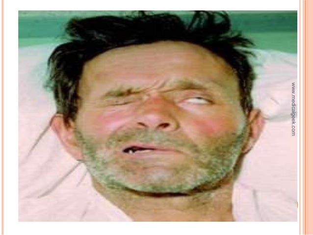 Tetanus Presentation