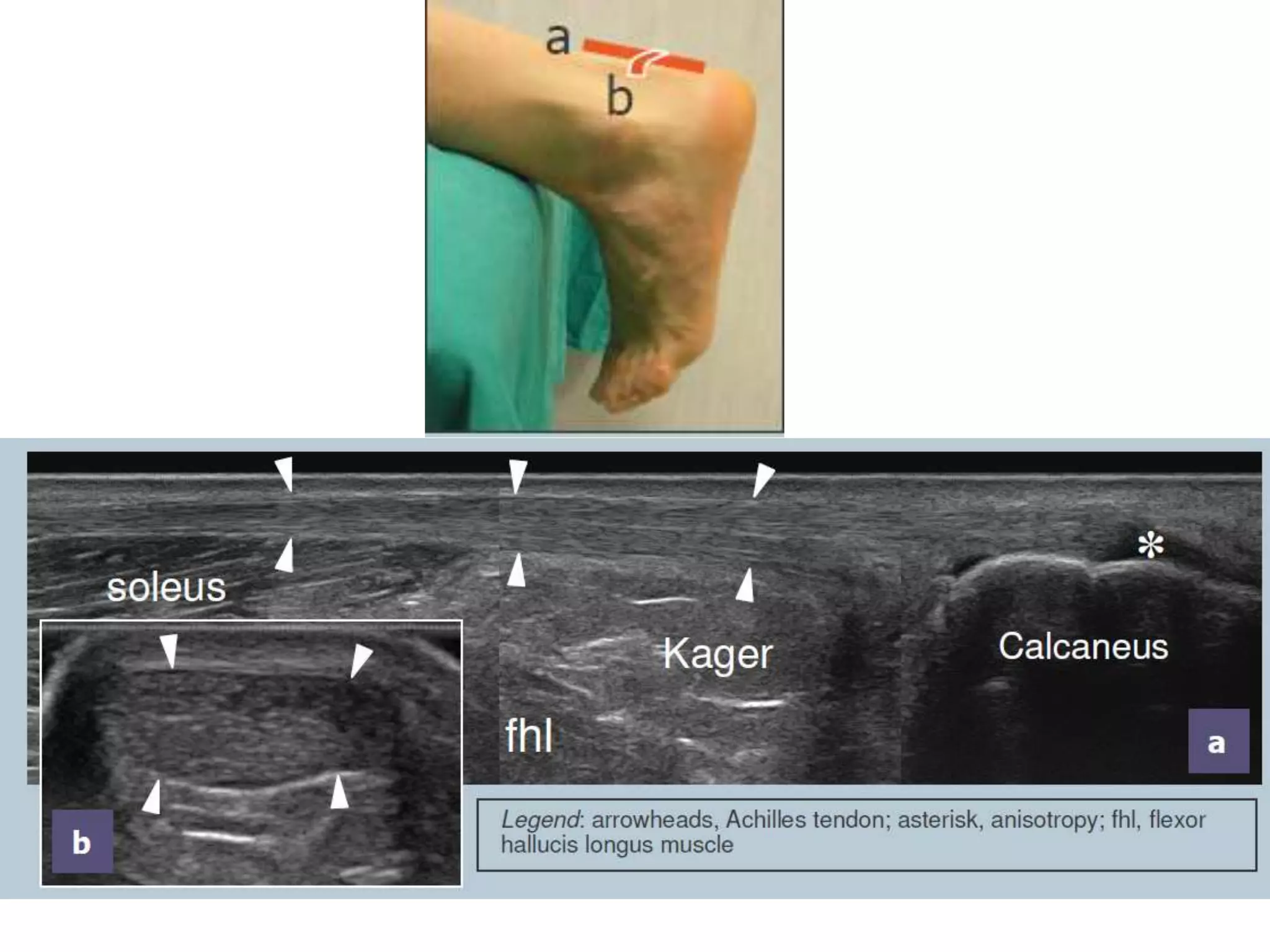 Ultrasound examination of the Ankle | PPTX