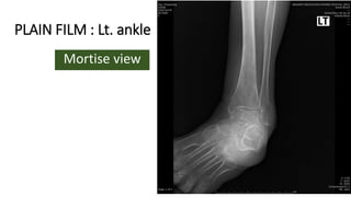 Ankle | PPT