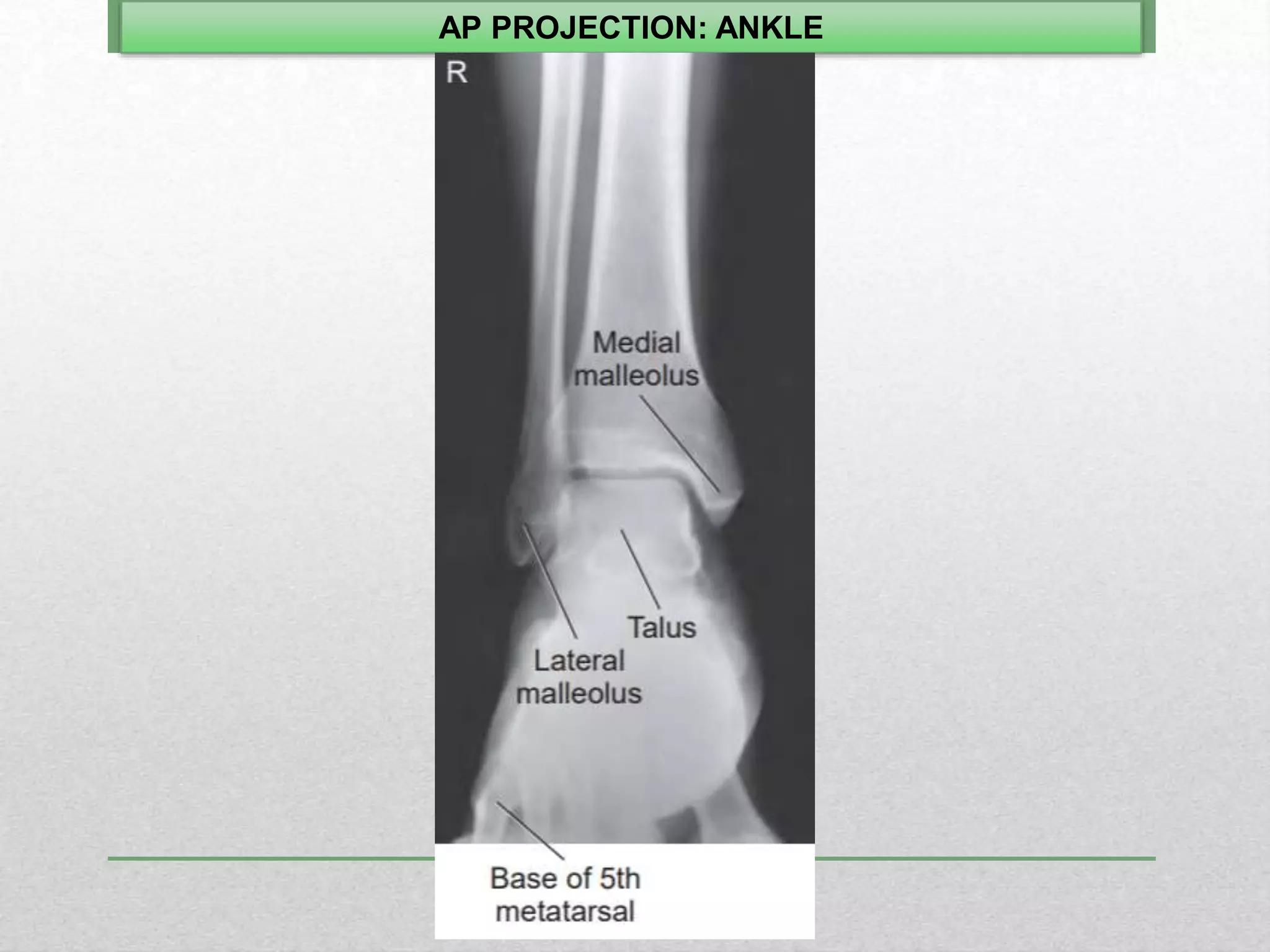 ankle.ppt