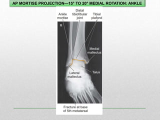 ankle.ppt