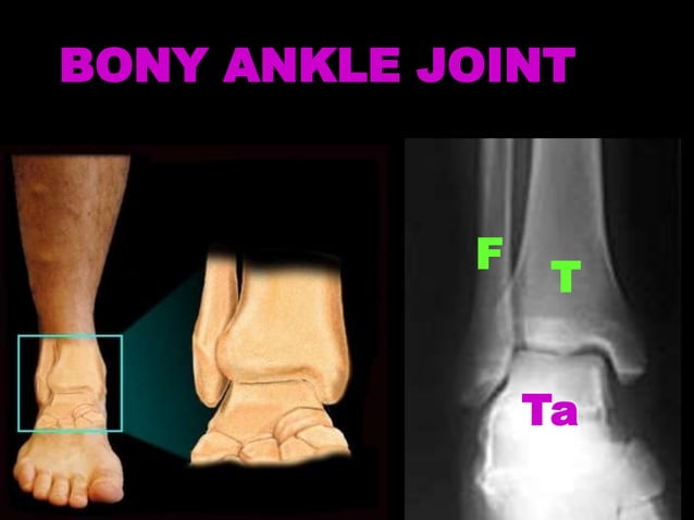 ANKLE.ppt | Death, Injury, or Military Conflict | Sensitive Topics