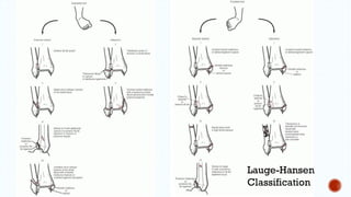 Ankle fracture | PPT