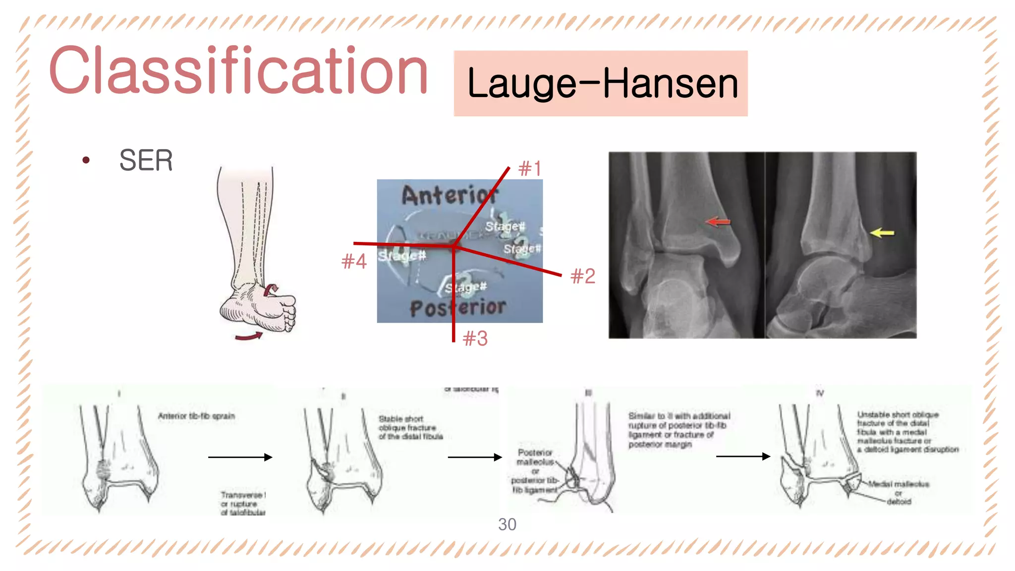 Ankle fracture-by-rgjel | PPTX