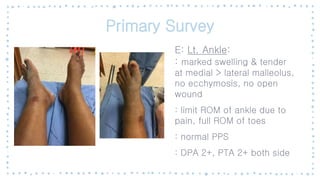 Ankle fracture-by-rgjel | PPT