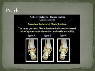 Bimalleolar Fracture | PPTX