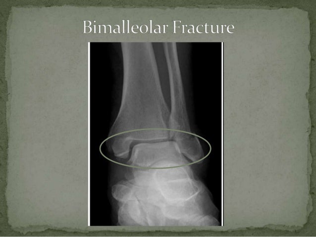 Bimalleolar Fracture