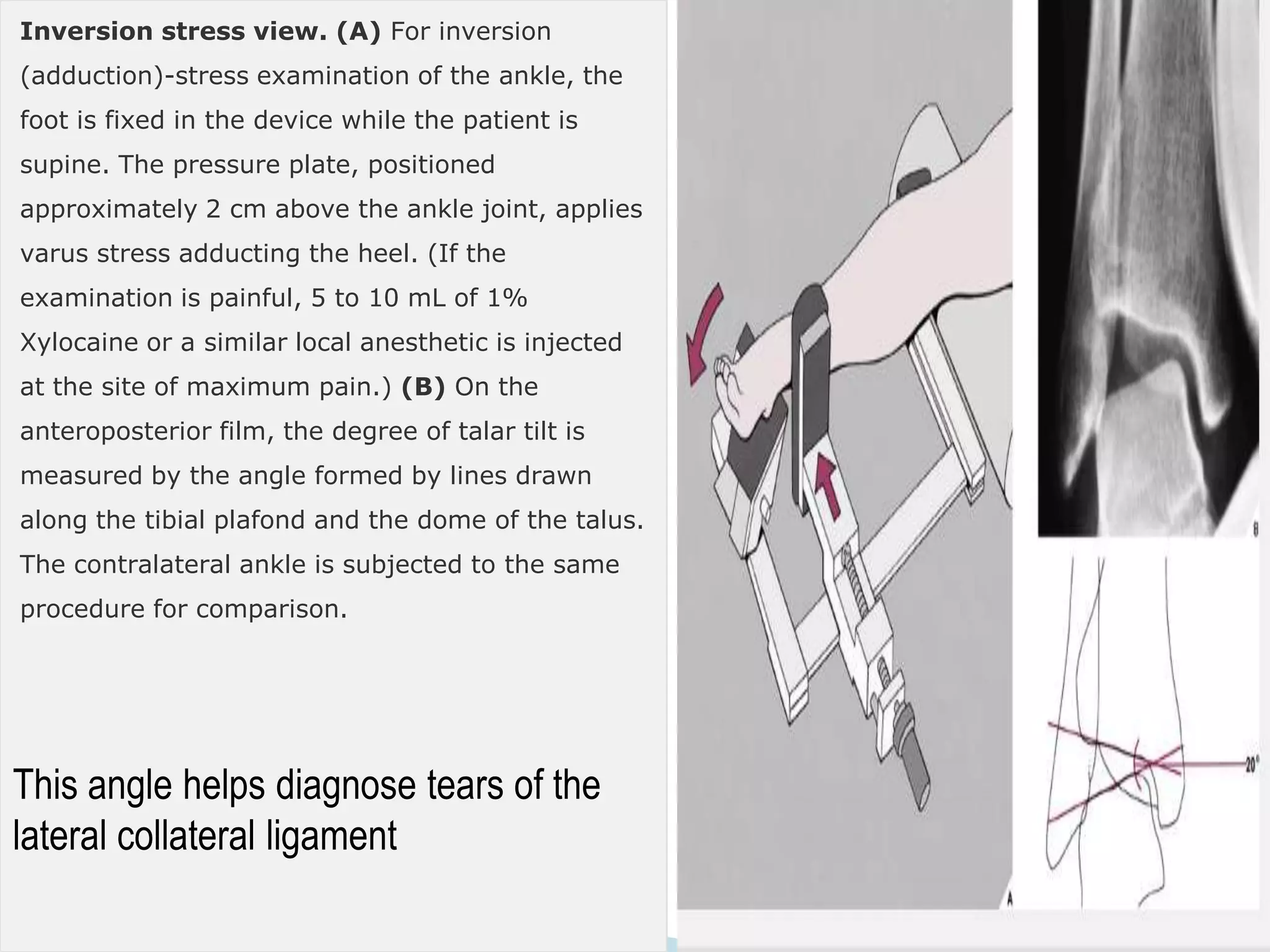 Ankle injury | PPTX