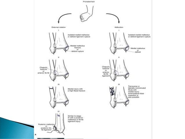 Ankle Hansen Lauge Classification Fractures Injuries Reduction Figure ...