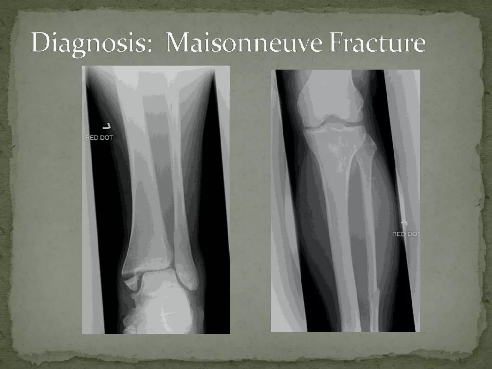 Maisonneuve Fracture | PPTX