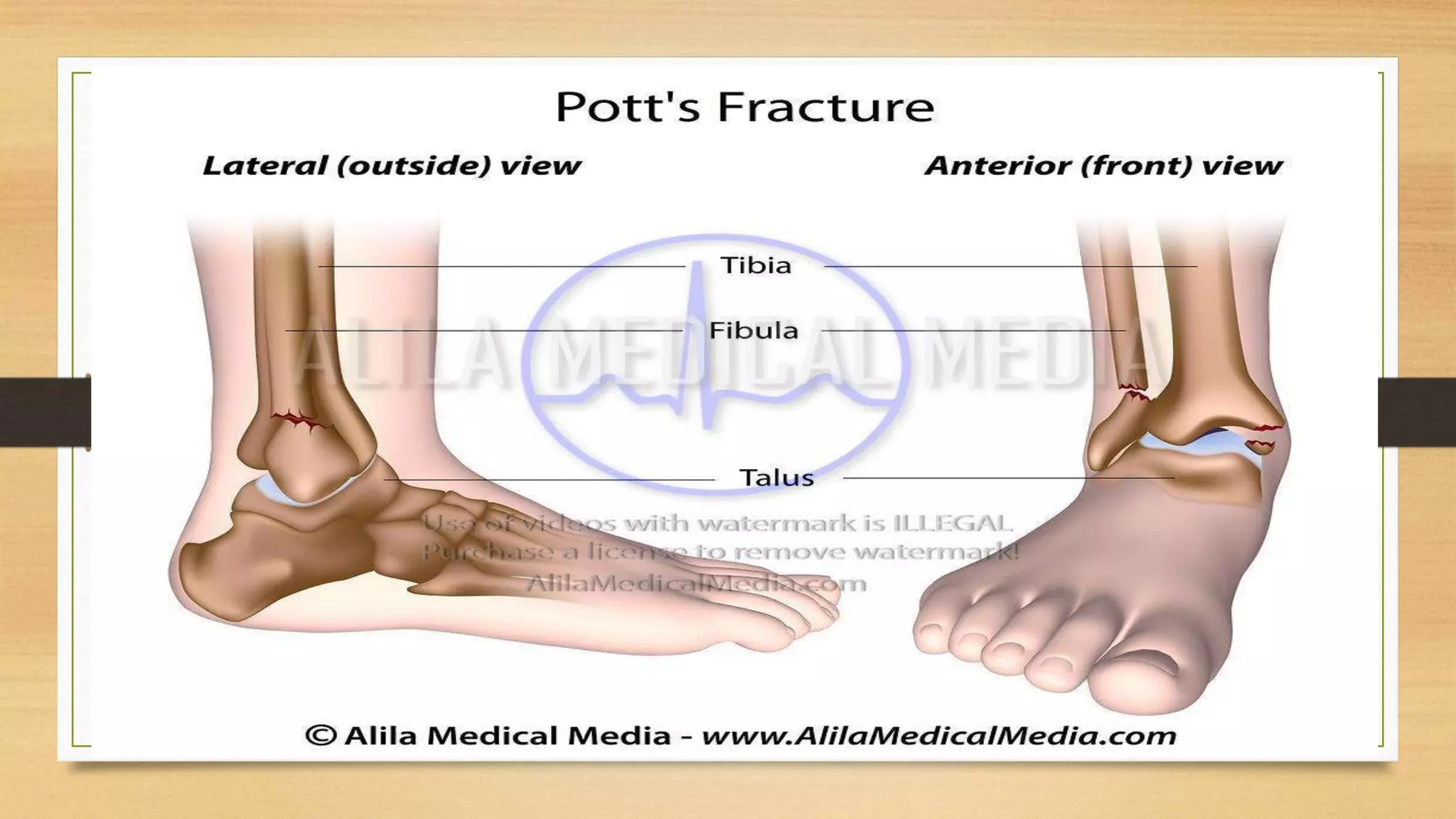 Ankle joint and tibiofibular joint | PPTX
