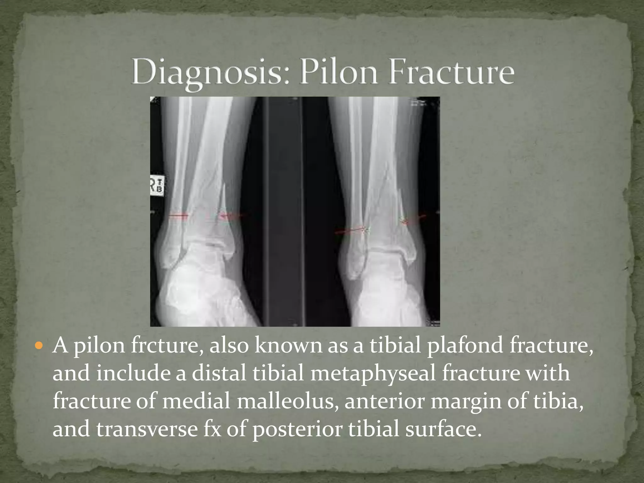 Pilon Fracture | PPTX