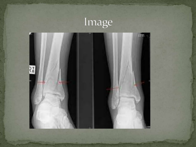 Pilon Fracture | PPT