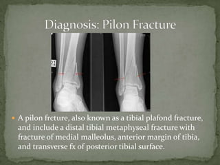 Pilon Fracture | PPTX