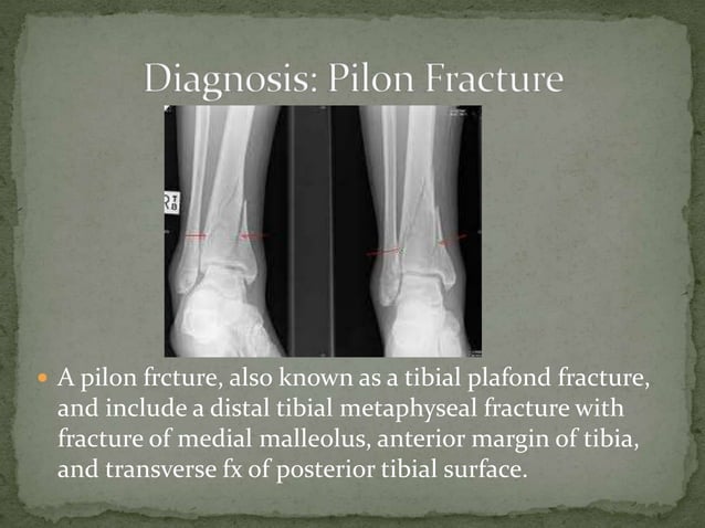 Pilon Fracture | PPT