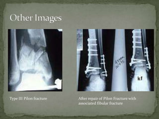 Pilon Fracture | PPTX