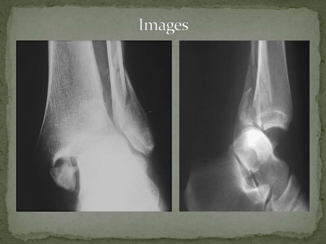 Trimalleolar Fracture | PPTX | Death, Injury, or Military Conflict ...