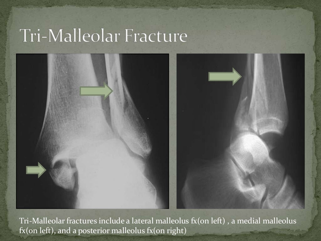 Trimalleolar Fracture