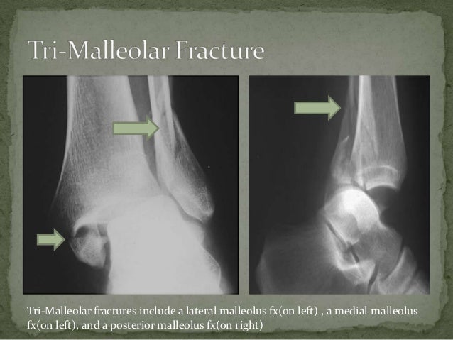 Trimalleolar Fracture